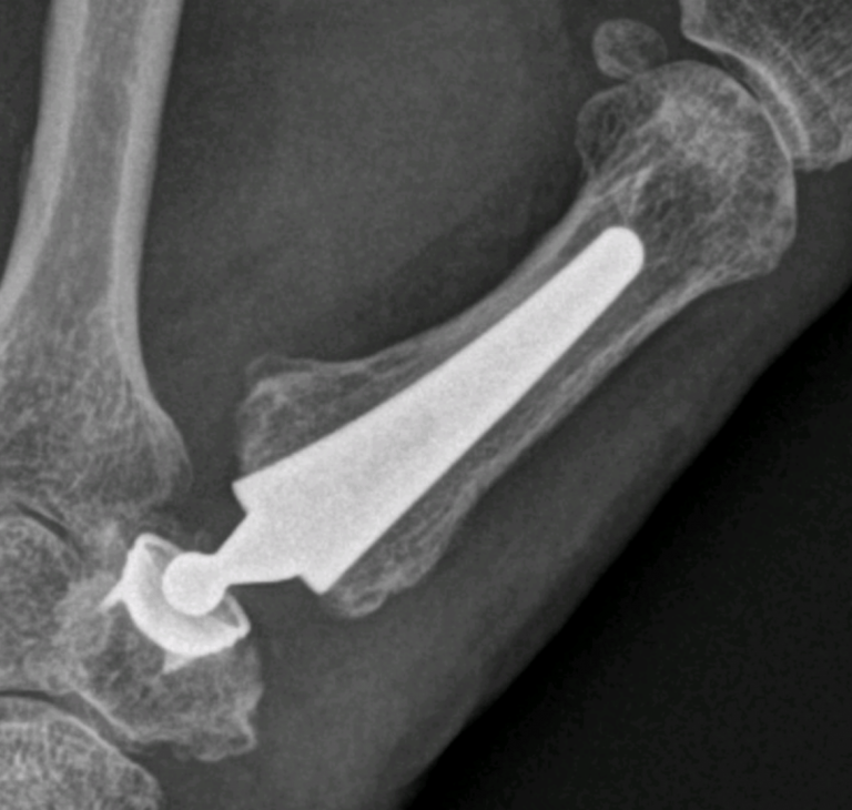 Duimartrose & duimprothese - Hand Centrum Limburg